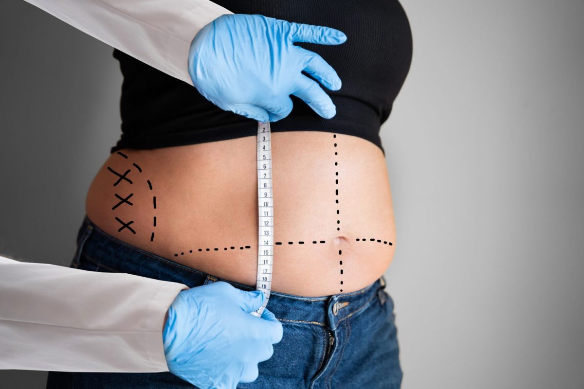 Abdominoplastie Ratée : les signes et les solutions pour y remédier